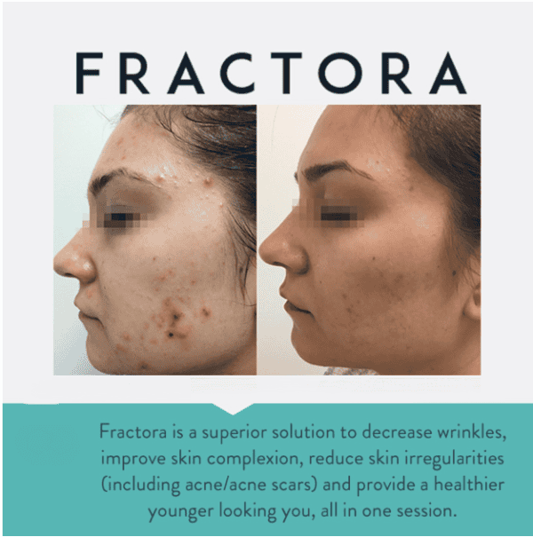 Fractora - Sunshine Cosmetic Clinic & Medi Spa