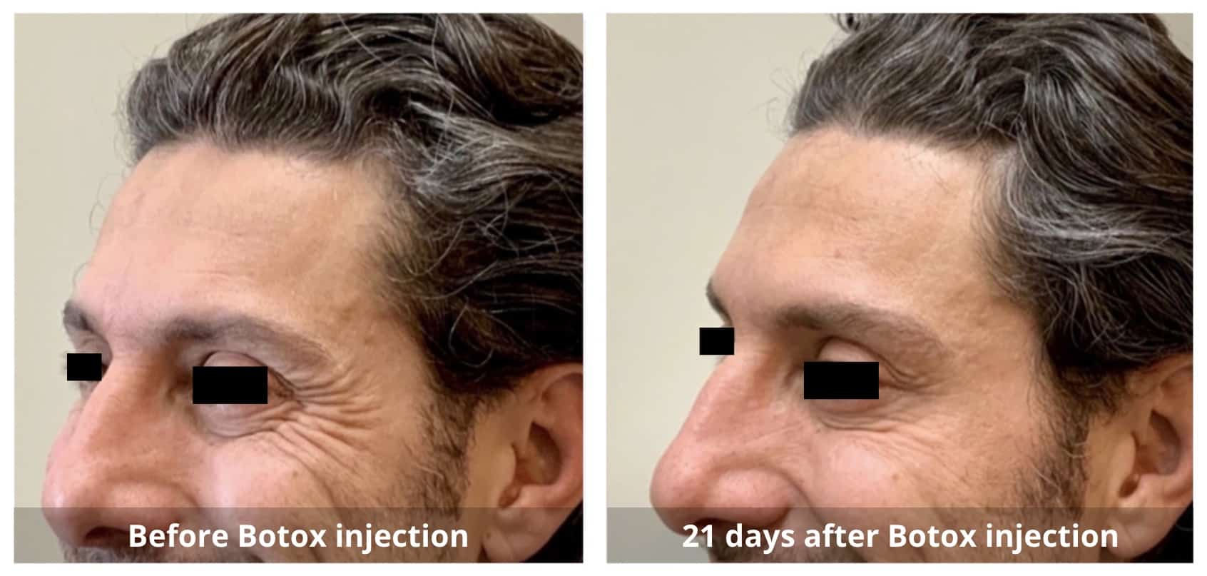 Botox injections in Waterloo, ON | Best Botox Near Me