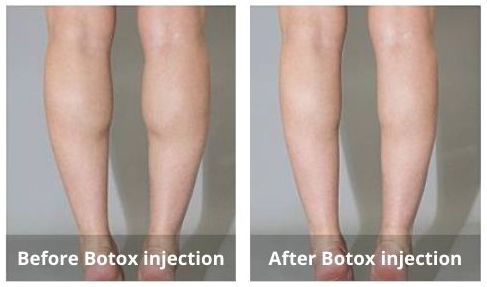 Botox injections in Waterloo, ON | Best Botox Near Me
