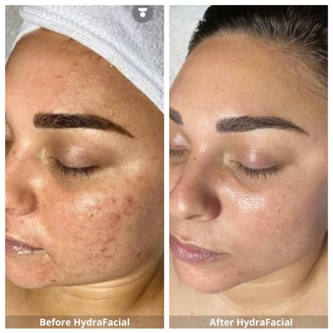 HydraFacial Waterloo, Kitchener, Cambridge | HydraFacial Near Me